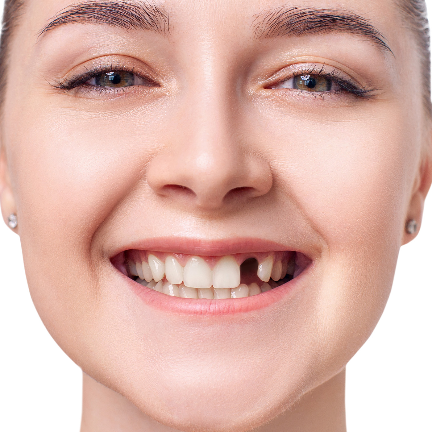 Dental Implants - Gordon Street Dental