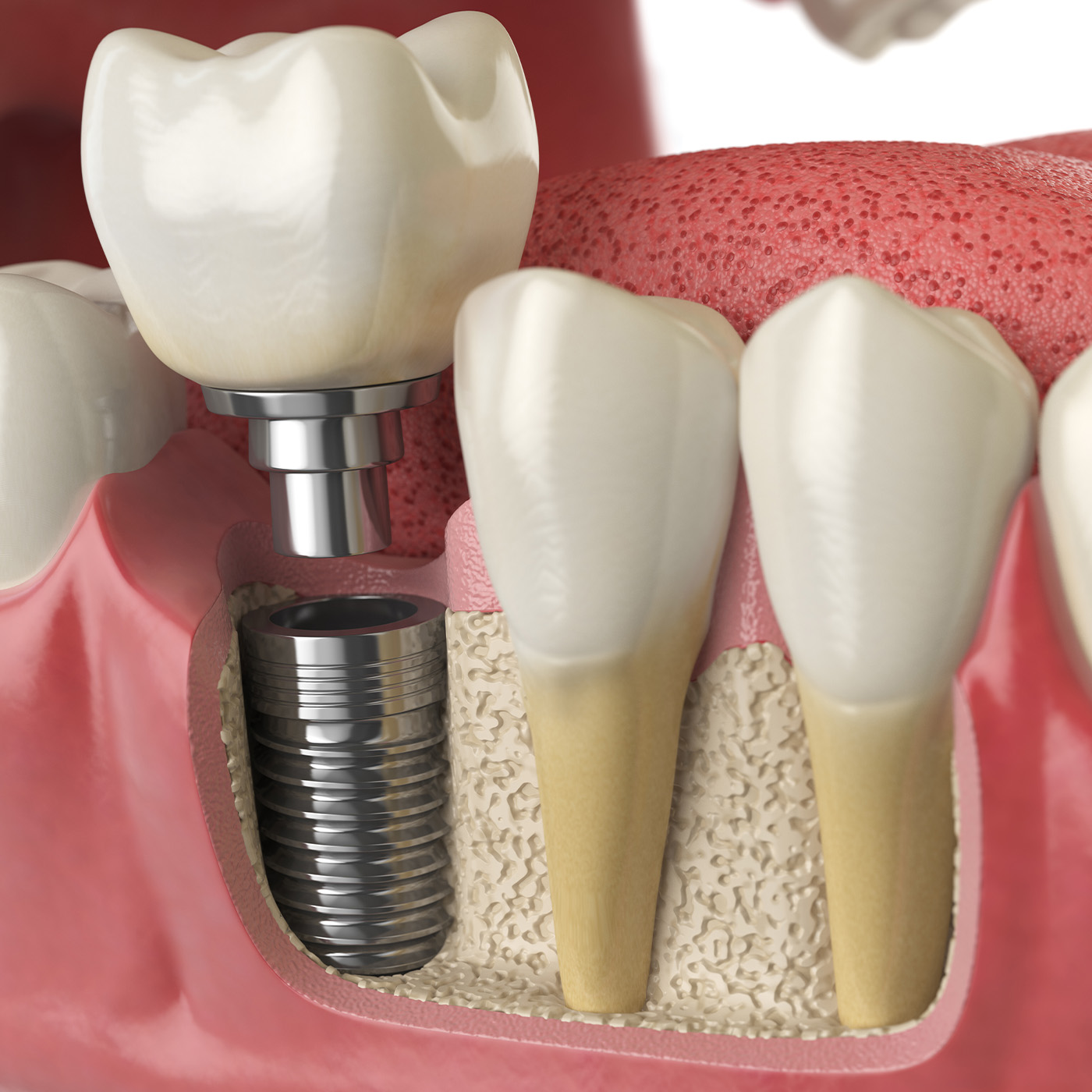 Dental Implants - Gordon Street Dental